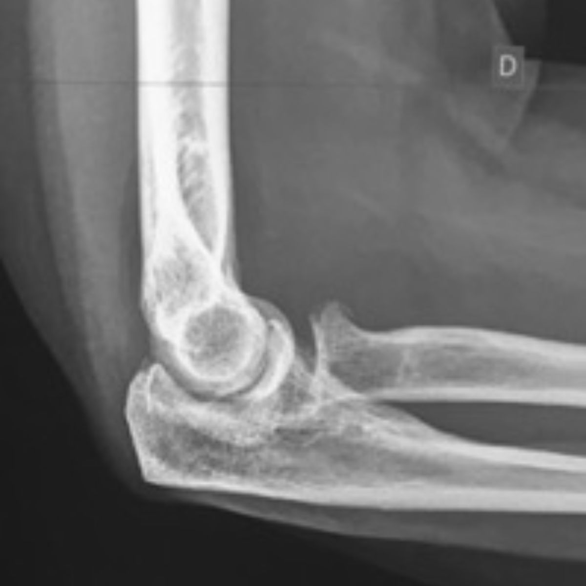 Fracture tête radiale - Var Membre Supérieur